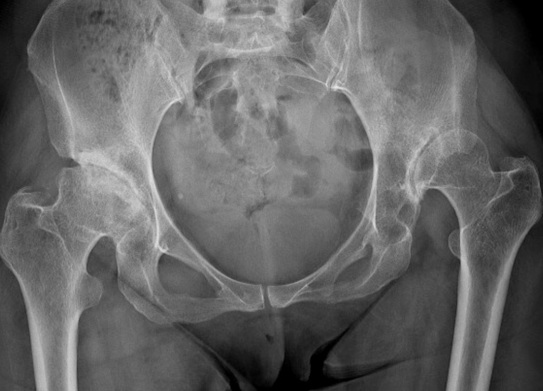 Artrosi anca secondaria: predisposizioni e cause | OrthoSport Group