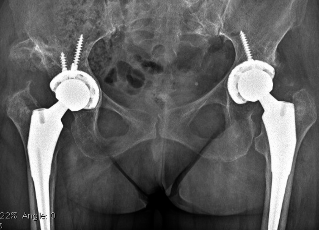 Artrosi anca secondaria: predisposizioni e cause | OrthoSport Group